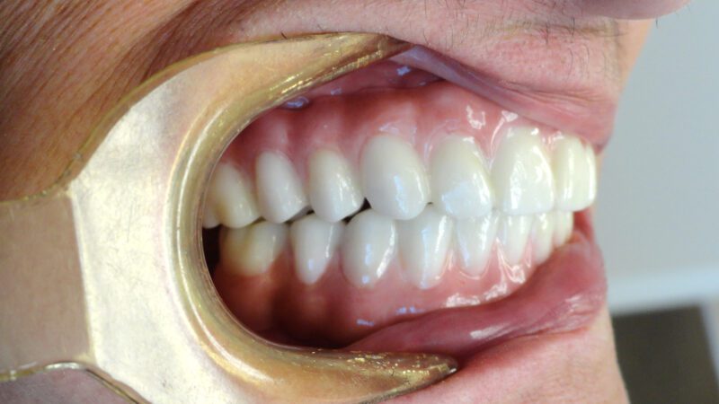 "All on 4" Full Zirconia Arch - Procedure - Utica Dental Laboratory