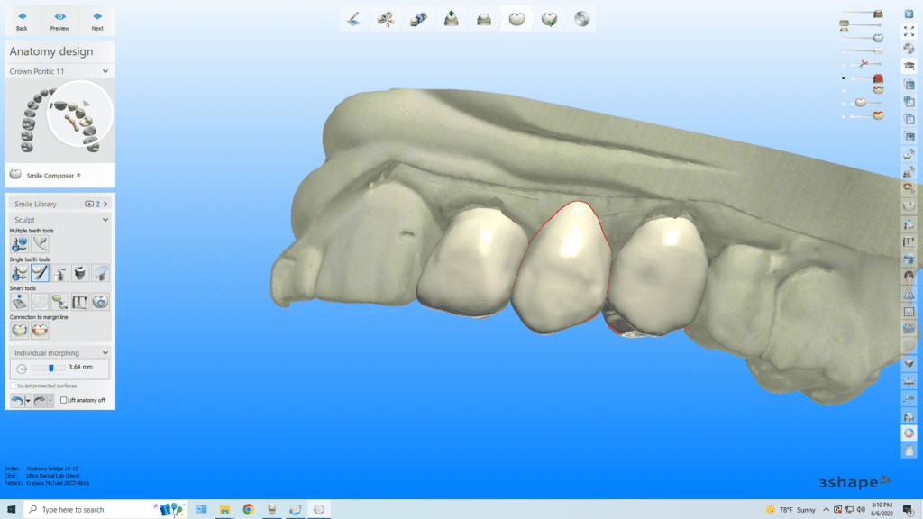 Crown and Bridge - Utica Dental Lab