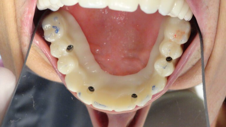 All on 4 Dental Implants - Utica Dental Laboratory