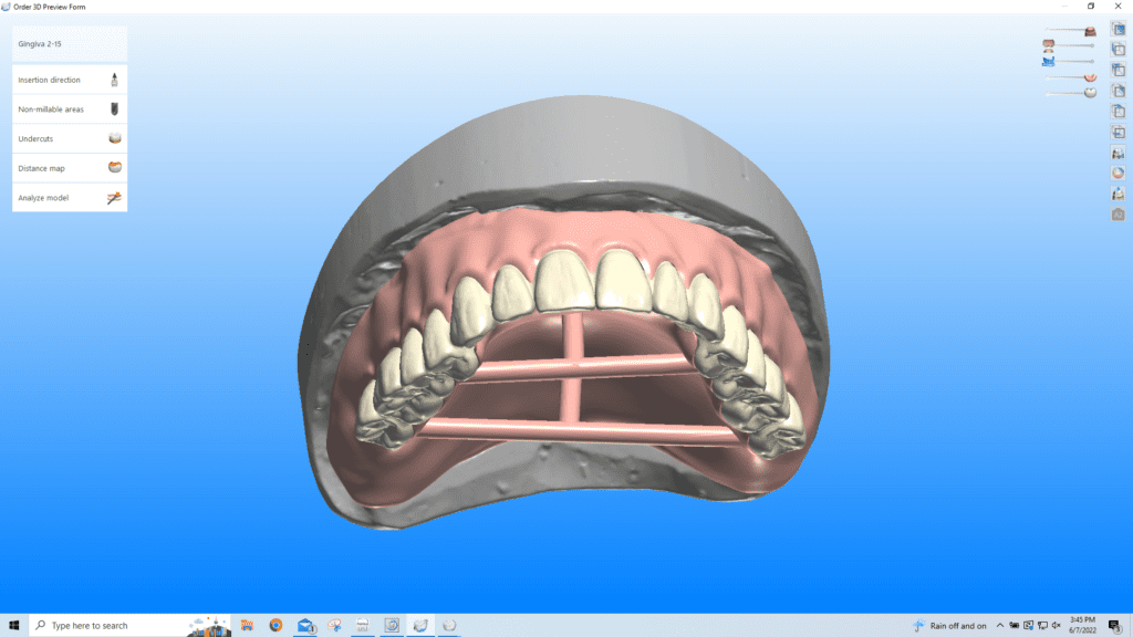 3D Printed Dentures - Utica Dental Laboratory