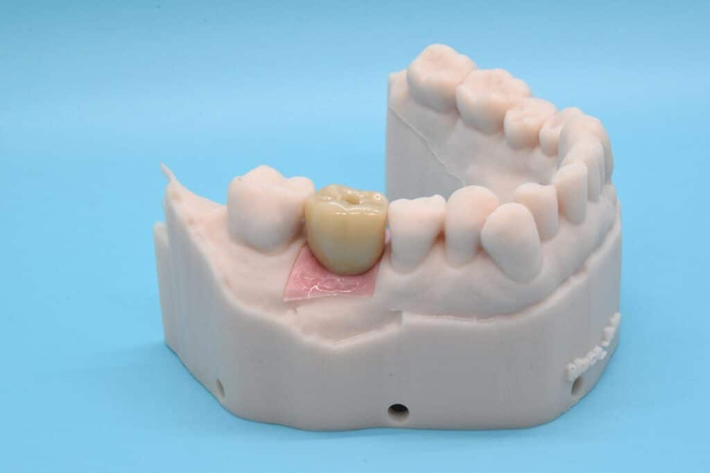 Implant Restorations - Utica Dental Lab