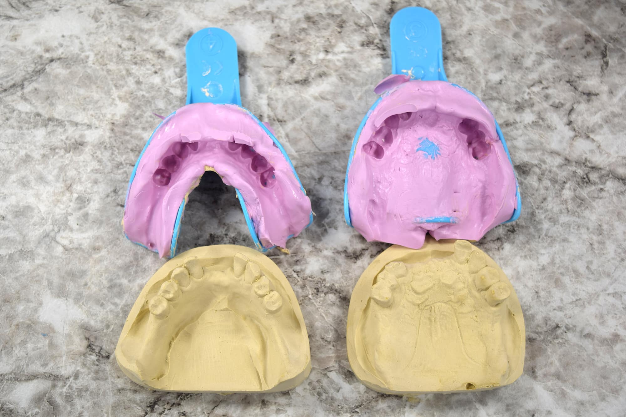 Traditional Dentures - Utica Dental Laboratory