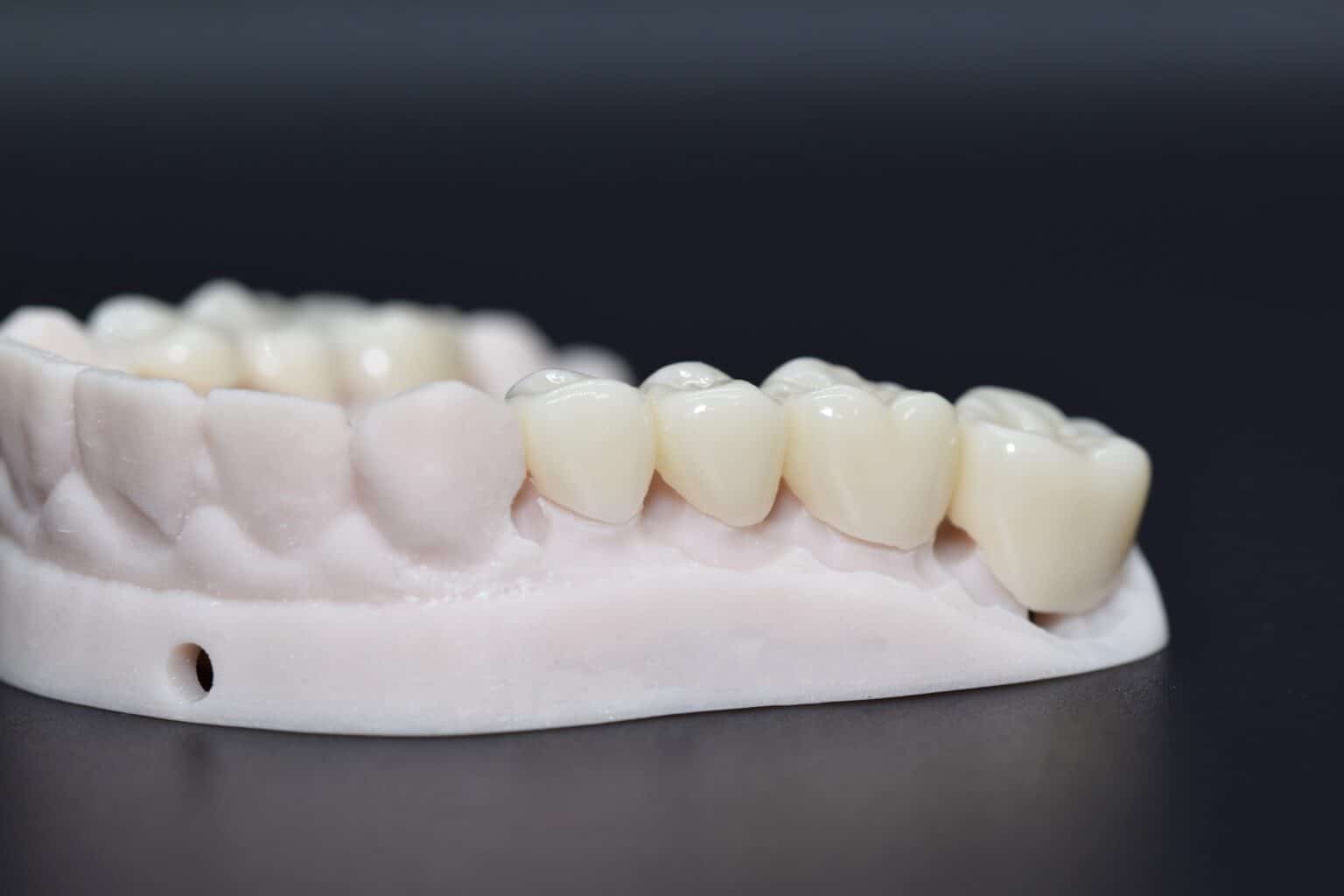 ZIRCONIA CROWNS - Utica Dental Laboratory