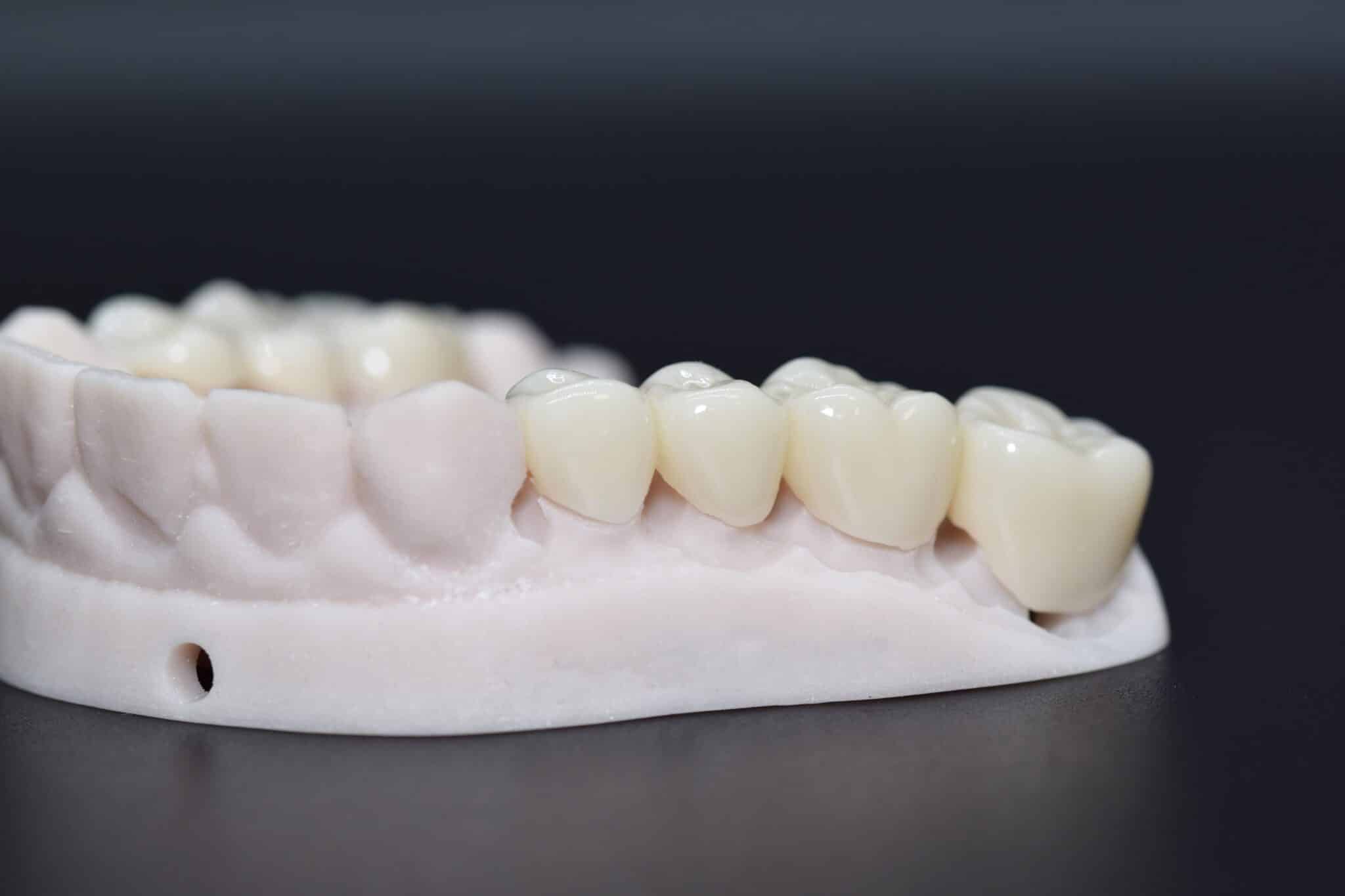 ZIRCONIA CROWNS - Utica Dental Laboratory