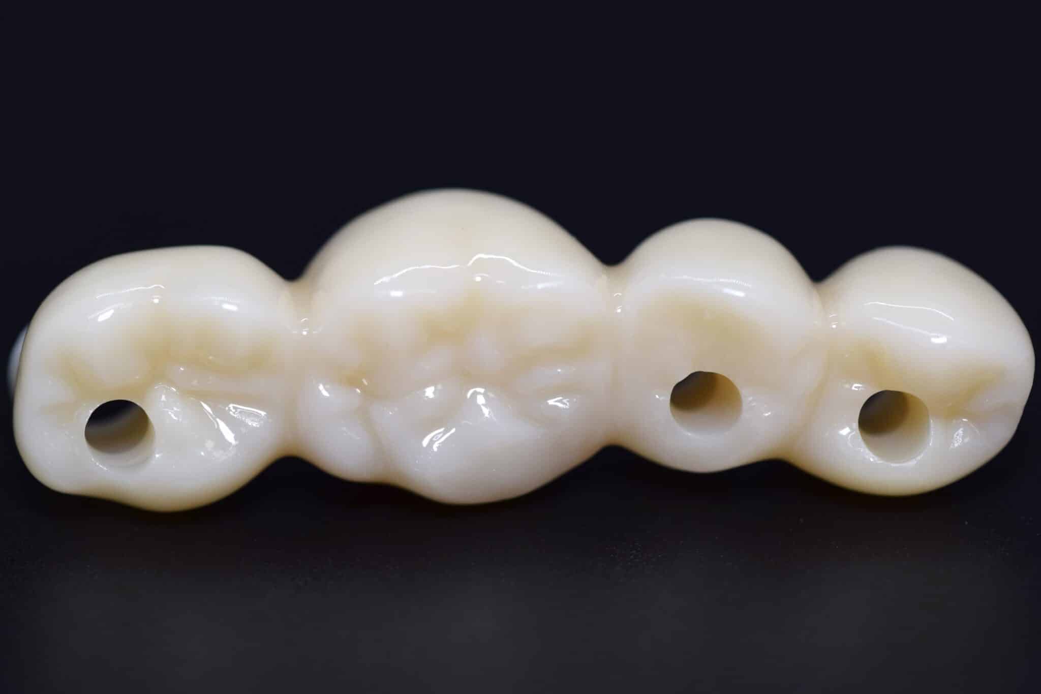 MILLED FULL METAL CROWNS - Utica Dental Laboratory